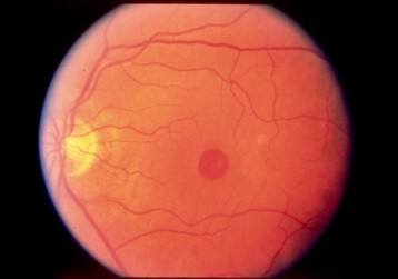 Trou maculaire | Rétine et vitré | Institut Català de Retina