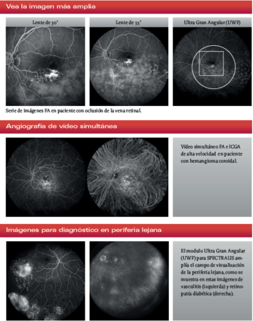 Ultra-Widefield (UWF) Angiography Equipment | ICR