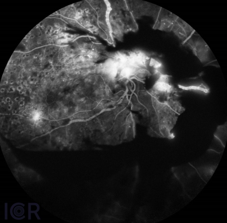Hemorragia vítrea. Pérdida de visión, borrosidad y moscas flotantes