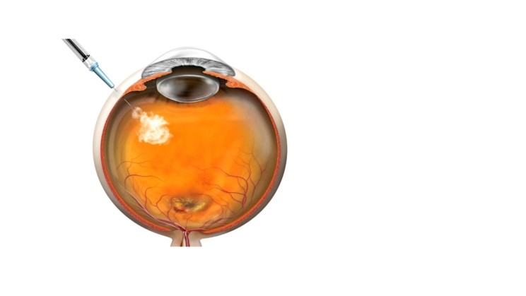 Intravitreal injections. What are they and what are they for? | ICR
