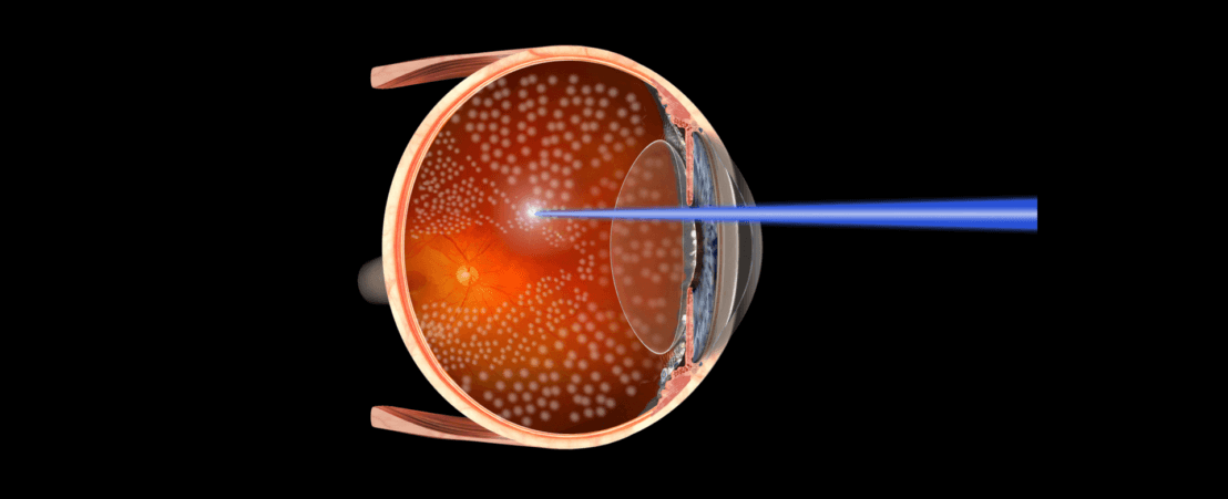 Laser photocoagulation | ICR Ophthalmology Center