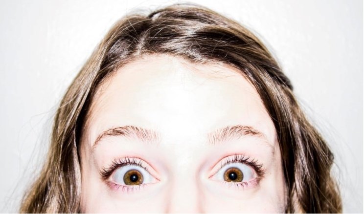 Hetereocromia u ojos de distinto color | Institut Català de Retina