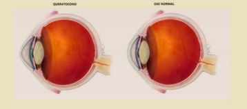 Queratocono. Causas, síntomas y tratamiento / ICR