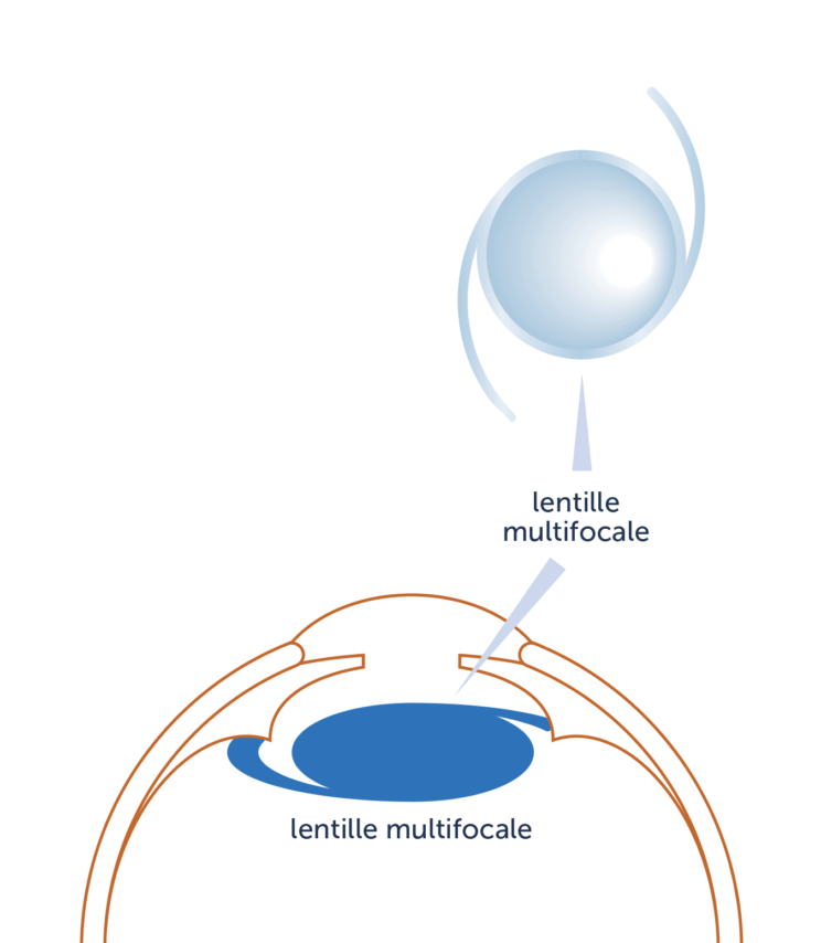 Chirurgie réfractive: myopie, hypermétropie, astigmatisme et presbytie