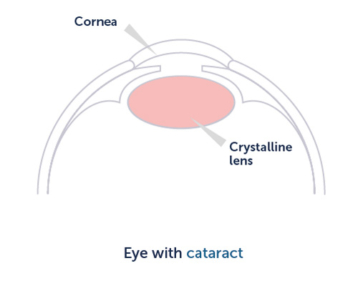 Cataract surgery. Intraocular lenses technology | ICR Barcelona