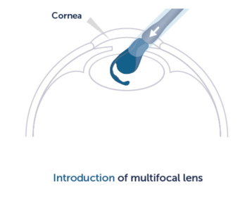Cataract surgery. Intraocular lenses technology | ICR Barcelona