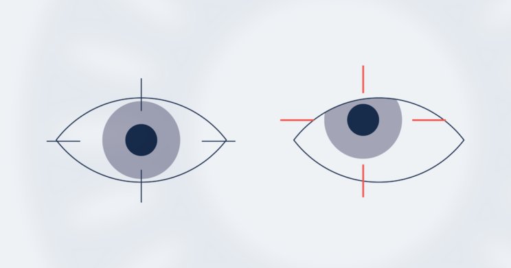 Strabismus. Eye misalignment | ICR | Ophthalmology Centre