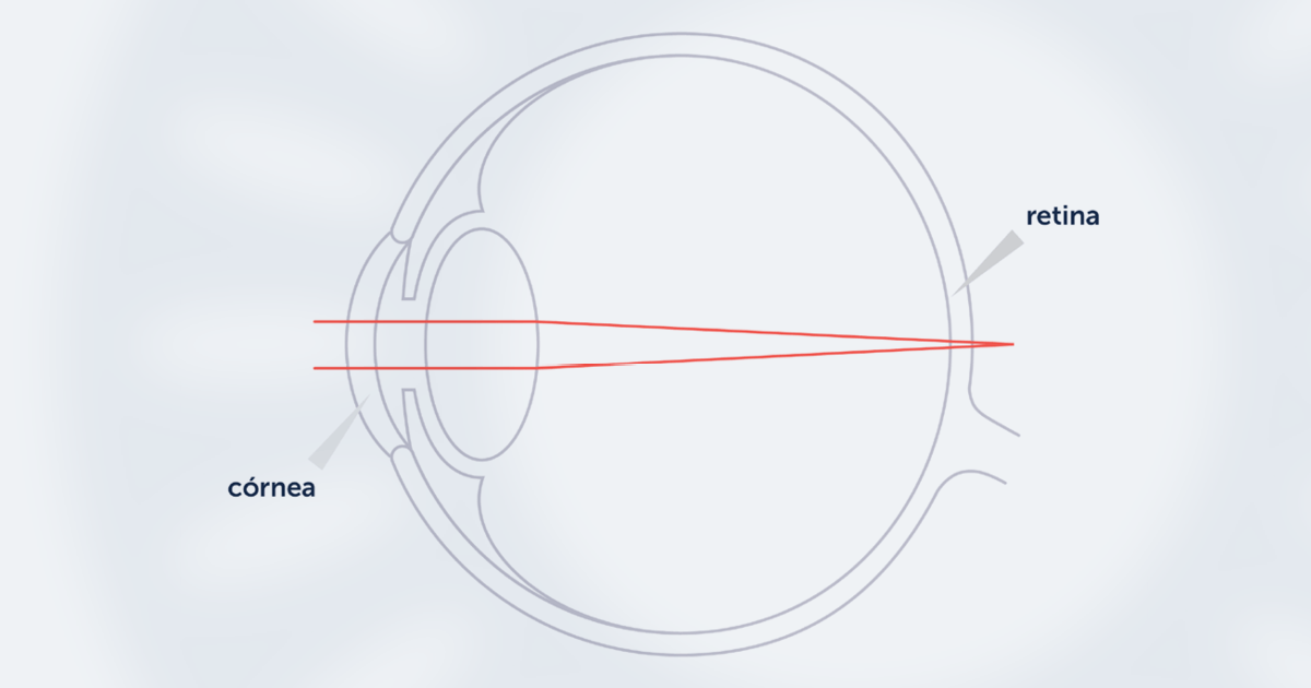 Hyperopia-Hypermetropia. Causes, diagnosis and treatments | ICR