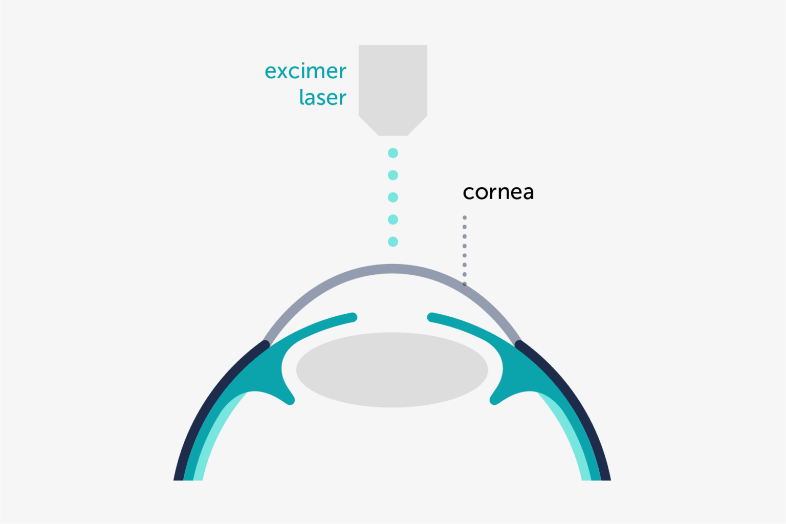 Refractive surgery: myopia, hyperopia, astigmatism or presbyopia