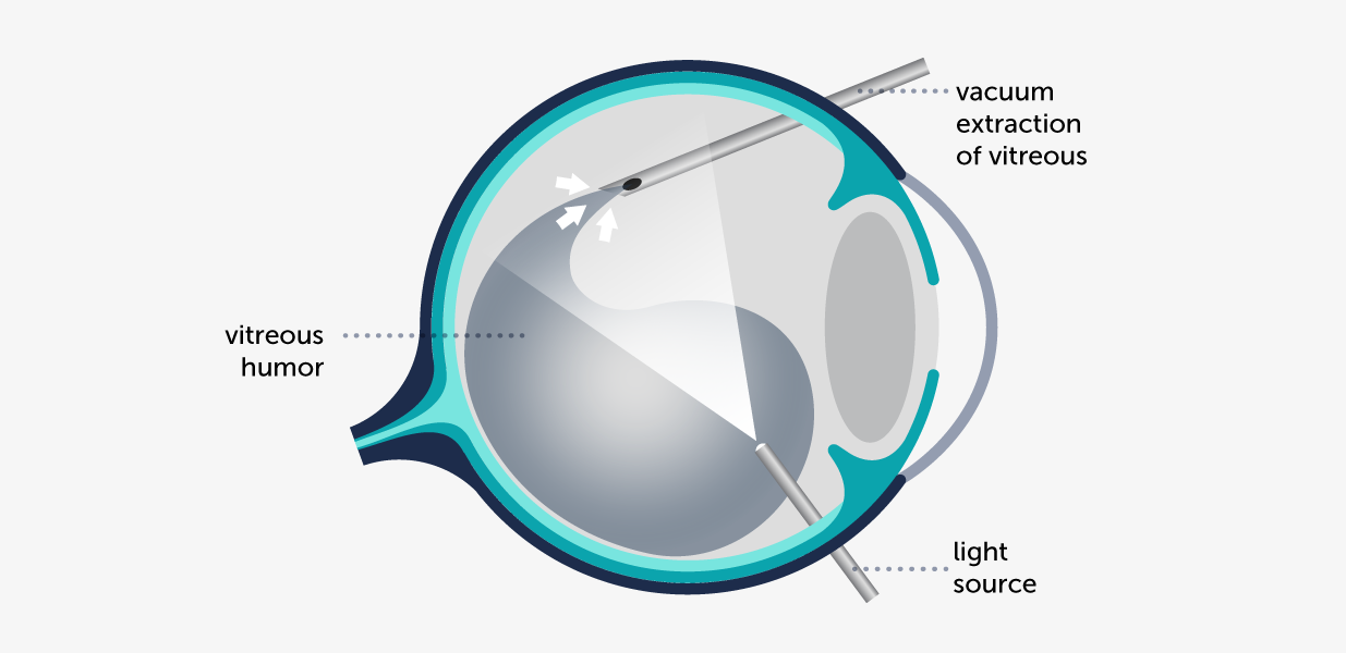 Vitrectomy | ICR Ophthalmology Center